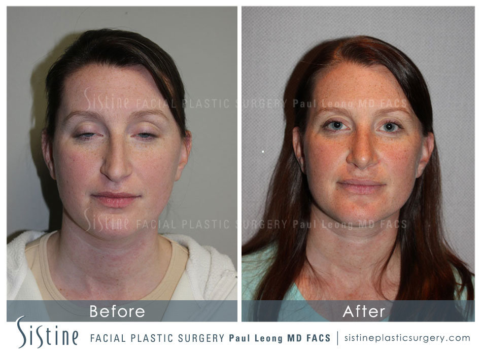 Nose Before and After 10 | Leong Facial Plastic Surgery